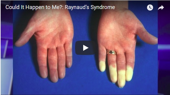 The Raynaud's Association - provide support and education to the ...